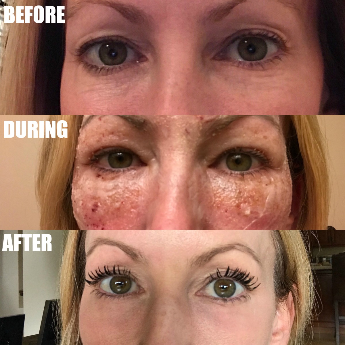 CO2 Laser Resurfacing Healing Stages